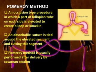 Permanent methods of family planning ppt.-BIJU | PPTX