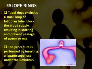 Permanent methods of family planning ppt.-BIJU | PPT
