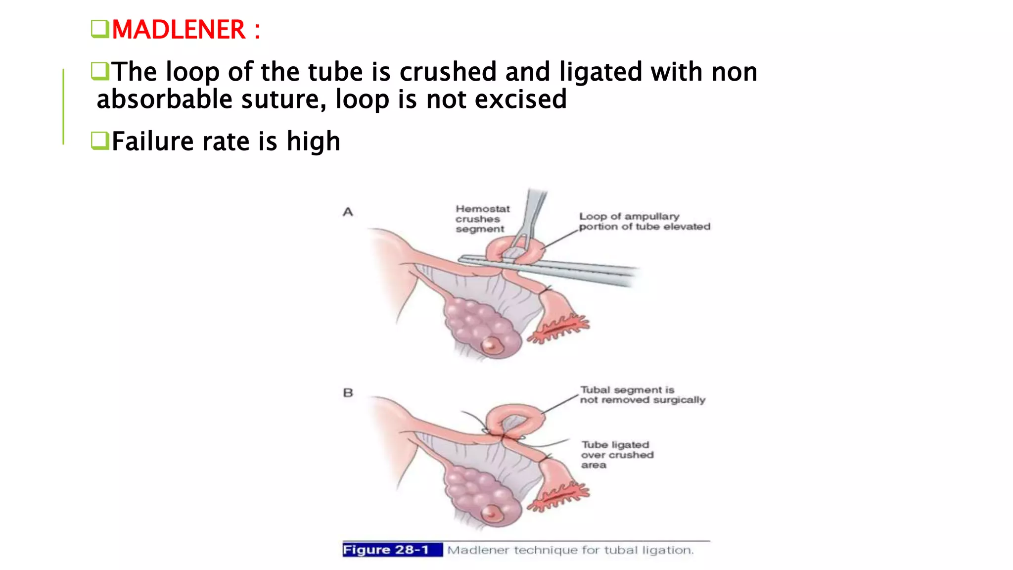 Permanent sterilisation.pptx