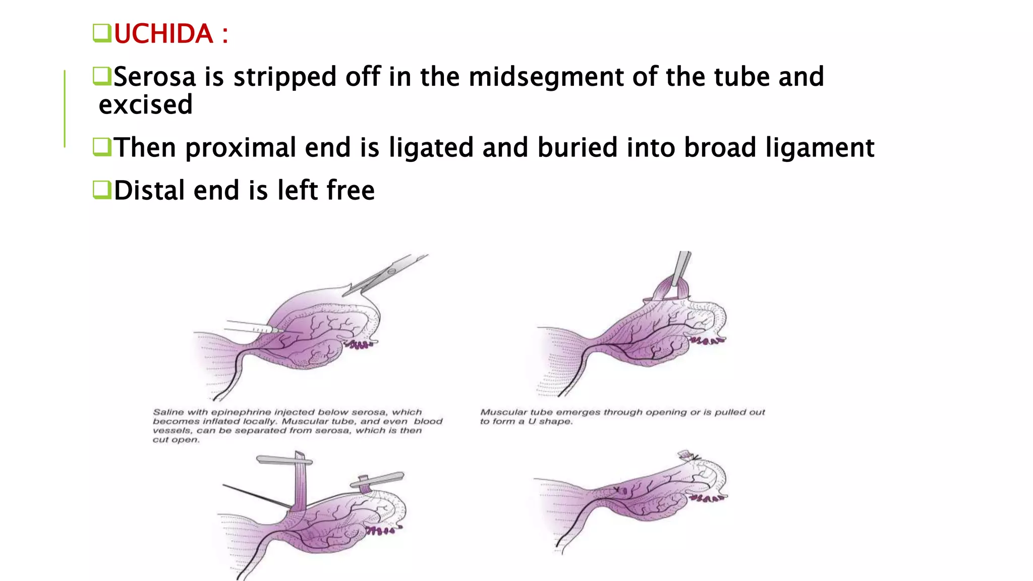 Permanent sterilisation.pptx