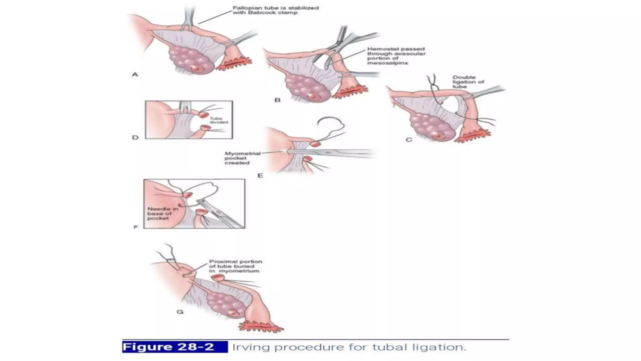 Permanent sterilisation.pptx