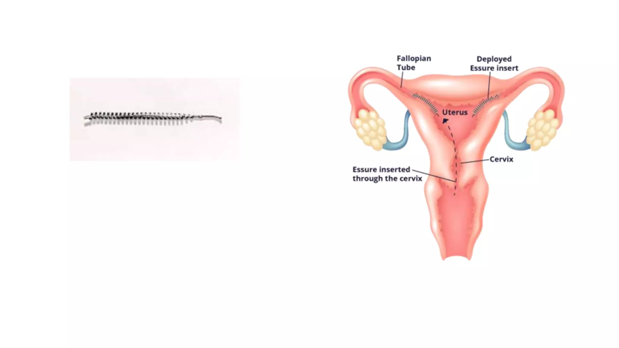 Permanent sterilisation.pptx