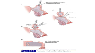 Permanent sterilisation.pptx