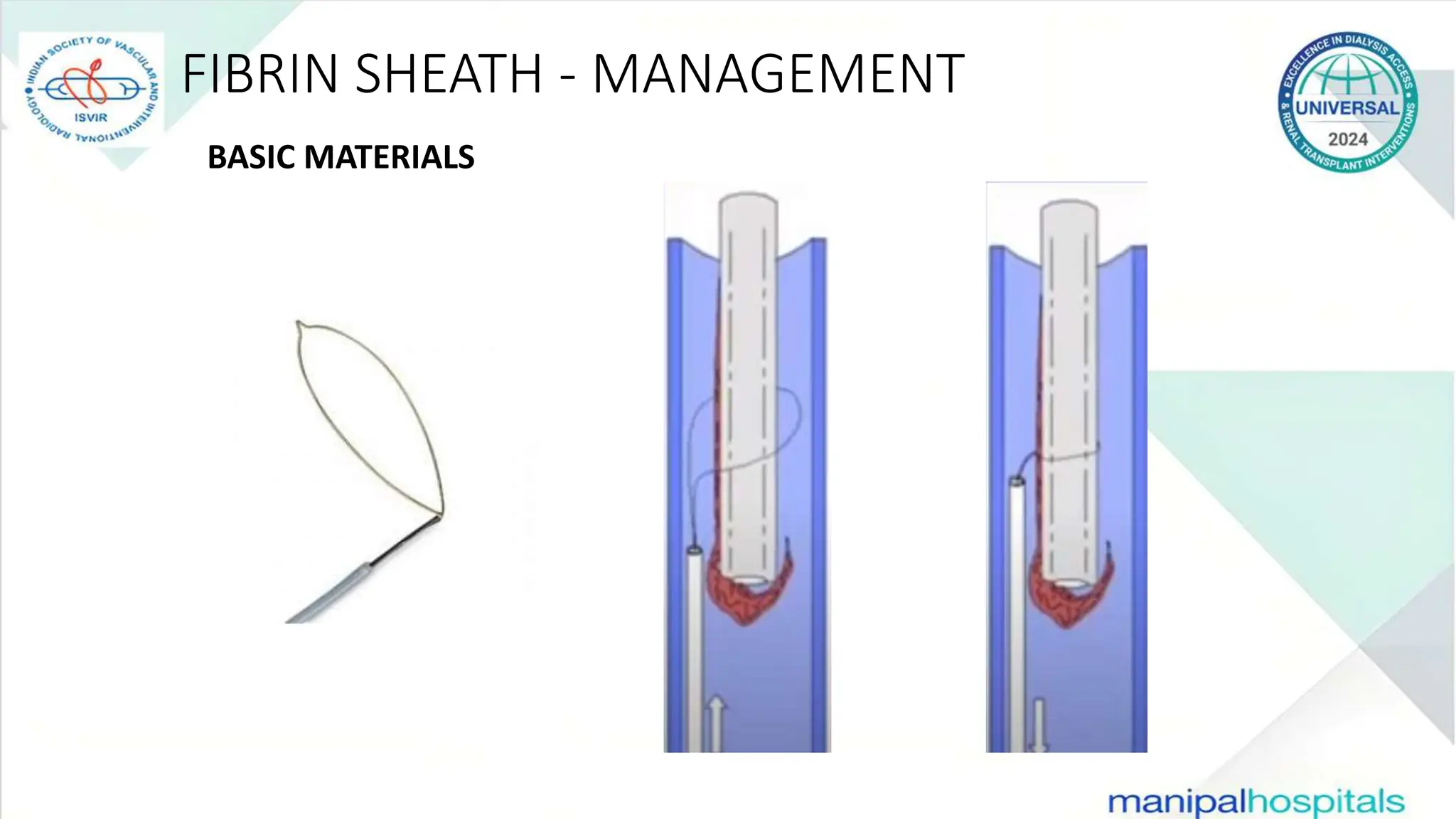 PERMCATH EXCHANGE AND FIBRIN SHEATH STRIPPING.pptx