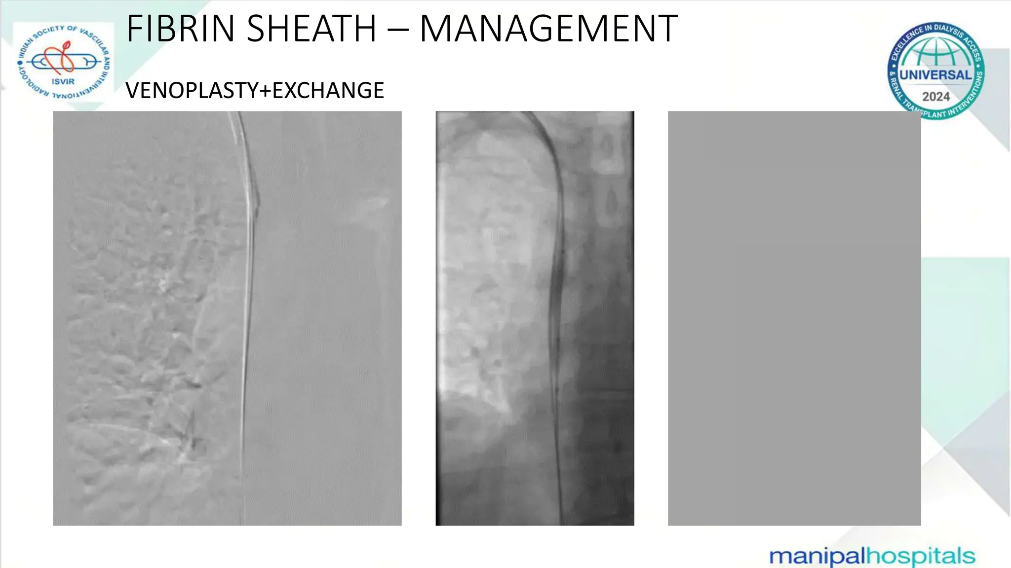 PERMCATH EXCHANGE AND FIBRIN SHEATH STRIPPING.pptx