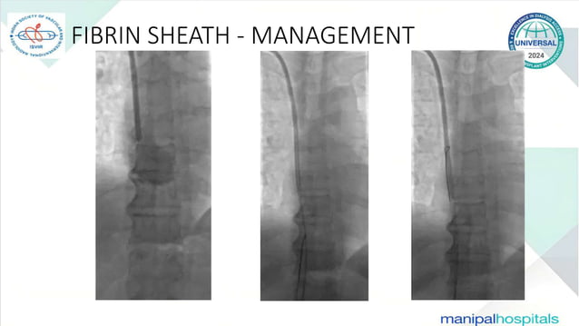 PERMCATH EXCHANGE AND FIBRIN SHEATH STRIPPING.pptx