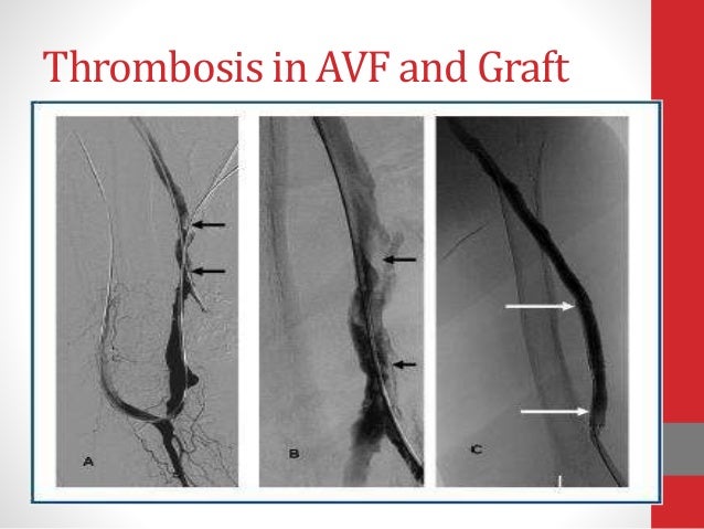 Permnent vascular access