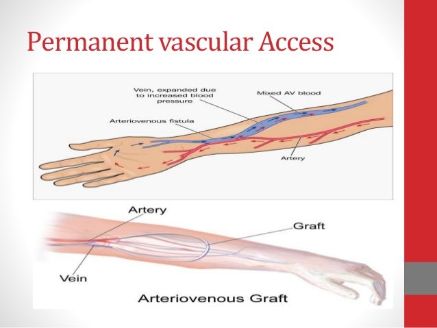 Permnent vascular access