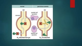 Pernicious Anaemia (pa) | PPTX