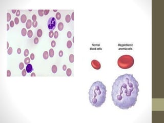 Pernicious Anemia Histology