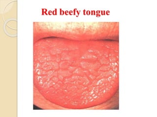 Pernicious Anemia Tongue