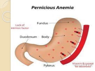 Pernicious Anemia Histology