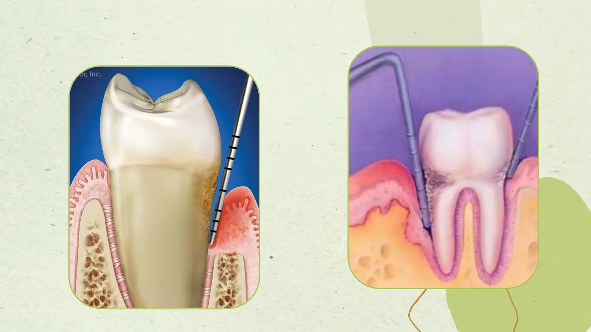 Perodontal Pocket-Formation,pathogenesis, treatment | PDF