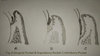Perodontal Pocket-Formation,pathogenesis, treatment | PDF