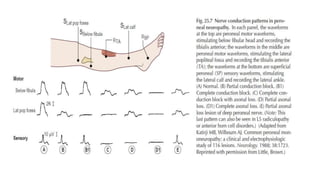 Peroneal neuropathy. sciatic neuropathyy | PPTX