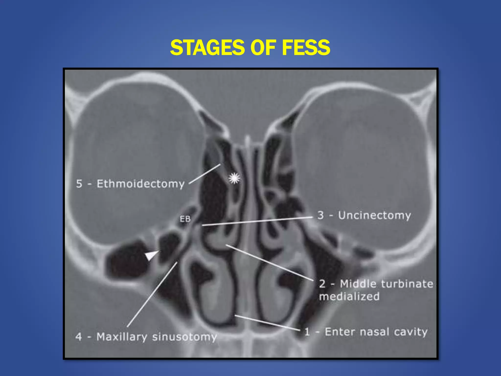 Peroperative PNS CT - A 10-steps evaluation | PPTX