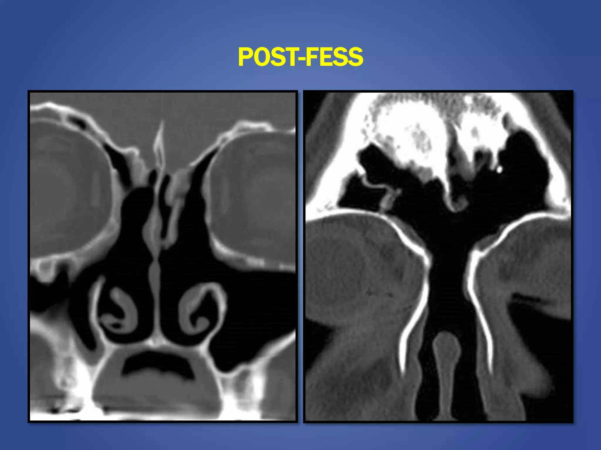 Peroperative PNS CT - A 10-steps evaluation | PPTX