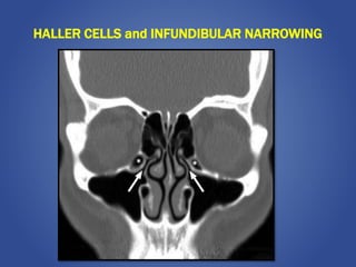 Peroperative PNS CT - A 10-steps evaluation | PPTX