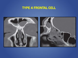 Peroperative PNS CT - A 10-steps evaluation | PPTX