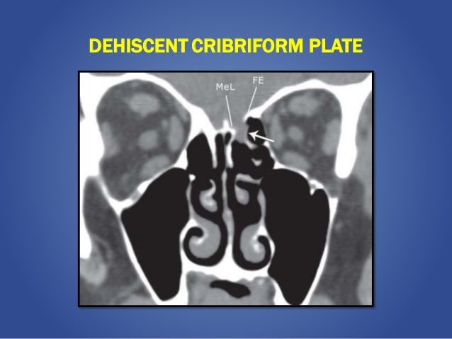 Peroperative PNS CT - A 10-steps evaluation