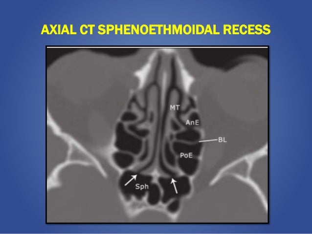 Peroperative PNS CT - A 10-steps evaluation