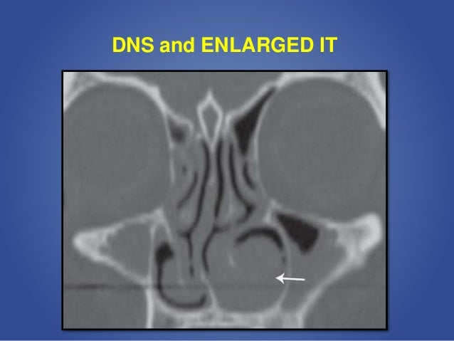 Peroperative PNS CT - A 10-steps evaluation