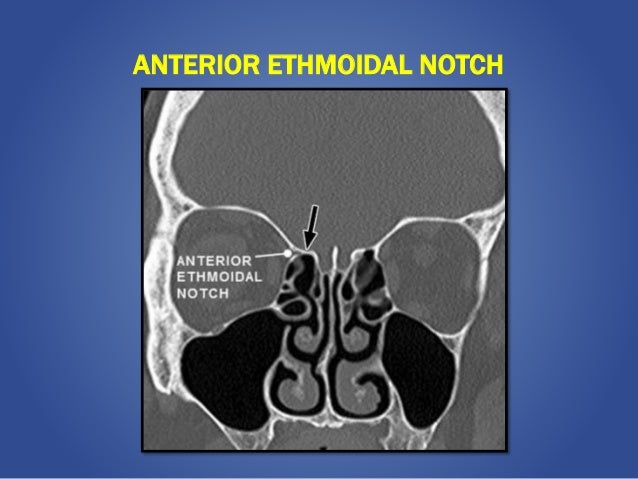 Peroperative PNS CT - A 10-steps evaluation