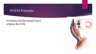 Peroral endoscopic myotomy | PPTX
