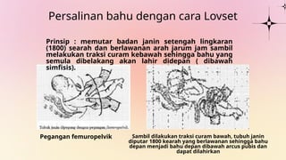 penatalaksanaan kegawatdaruratan Persalinan Sungsang dan distocia Bahu ...