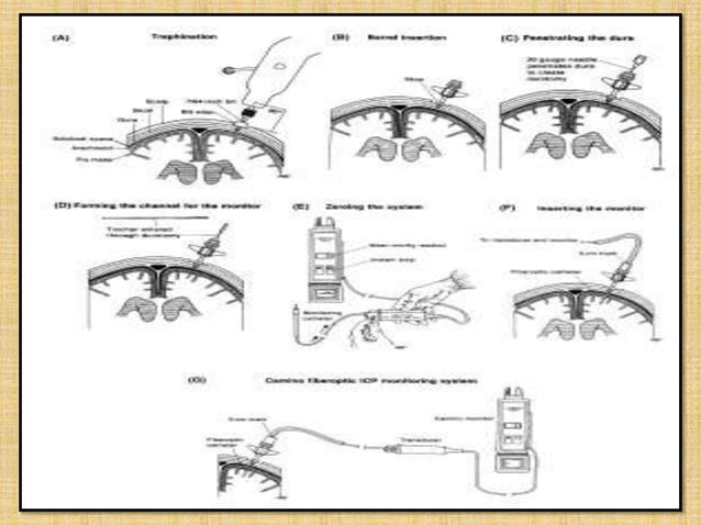 Presentasi Tekanan Intrakranial | PPTX