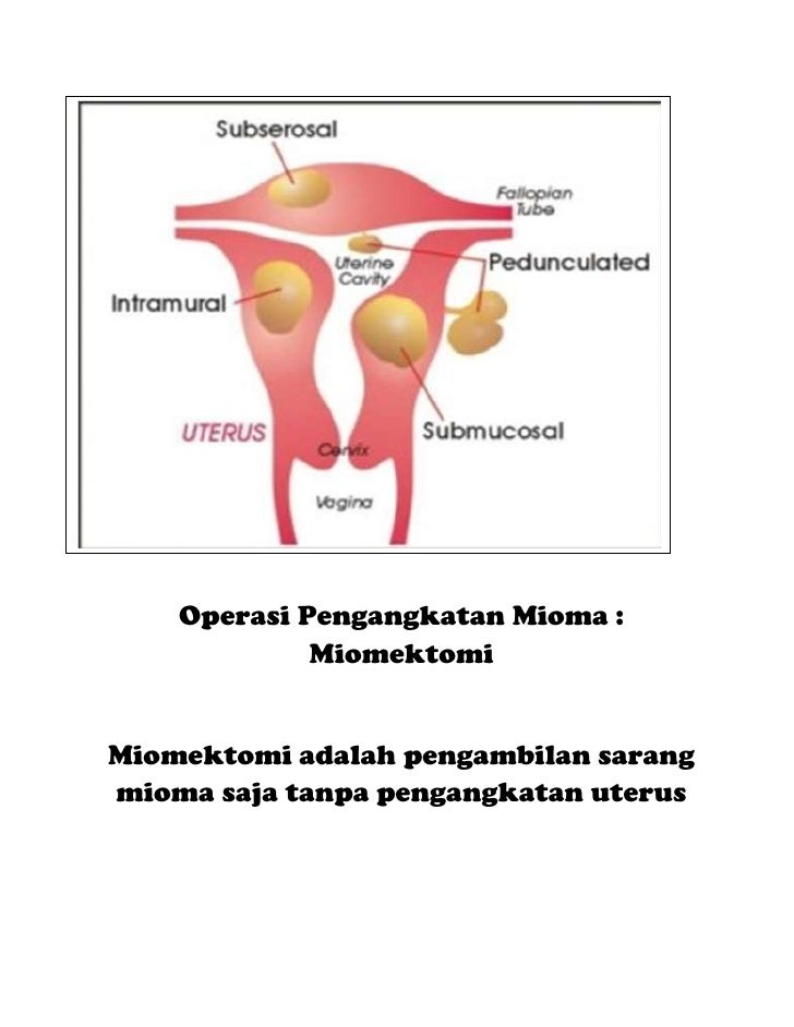 Myoma Uteri Presentation