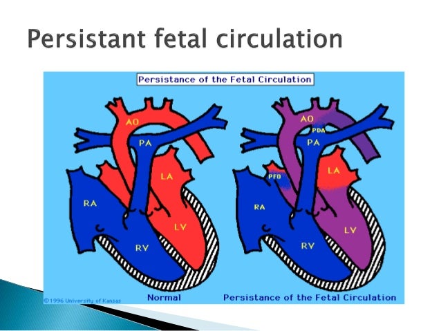 Persistent fetal circulation