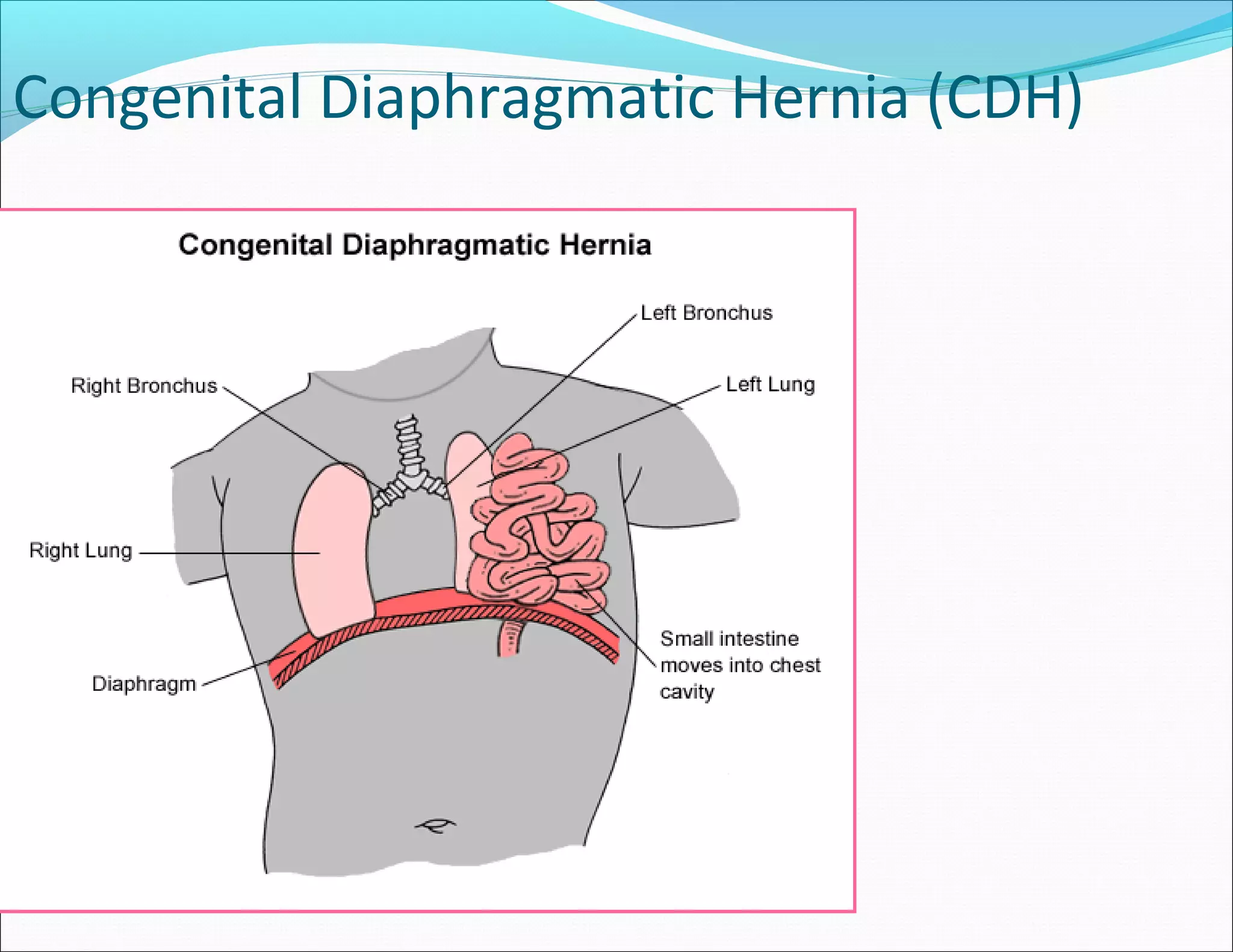 Persistent Pulmonary Hypertension by Dr. Joshua Petrikin, Neonatology ...