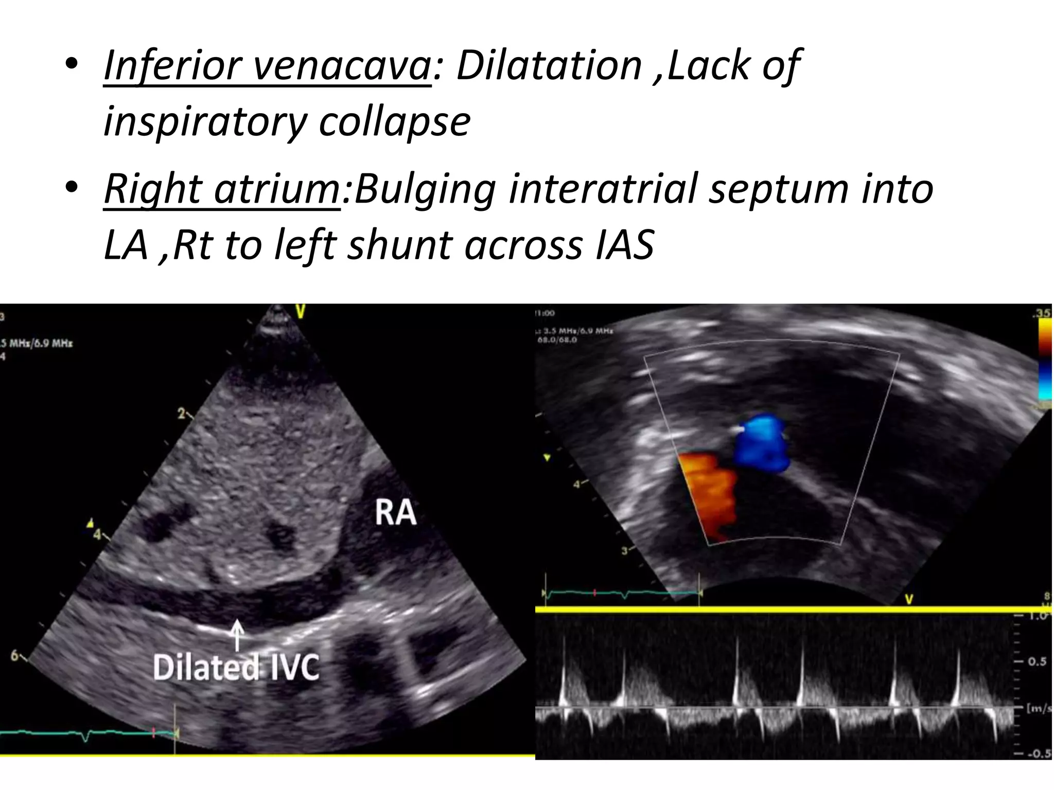Persistent pulmonary hypertension of newborn PPHN | PPTX