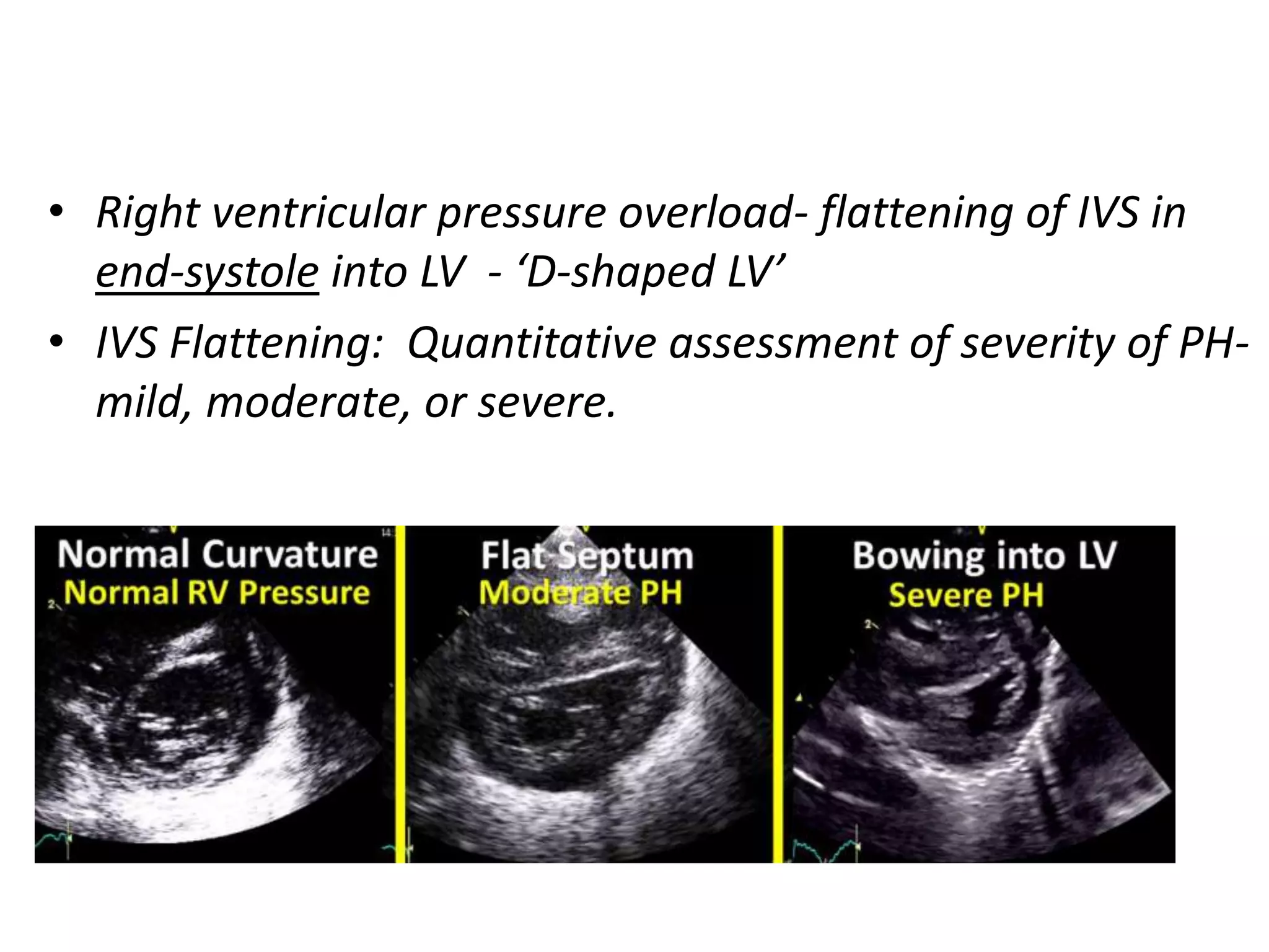Persistent pulmonary hypertension of newborn PPHN | PPTX