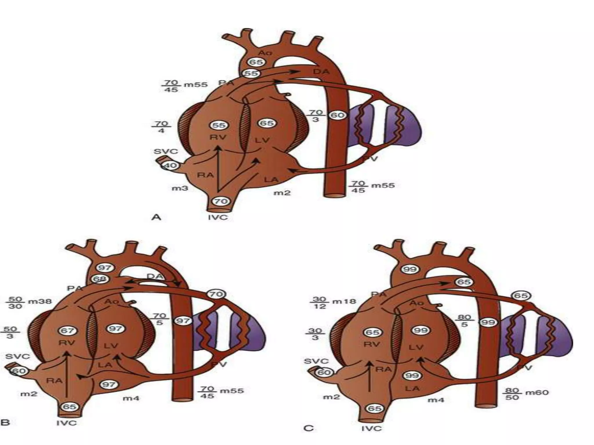 Persistent pulmonary hypertension of newborn PPHN | PPTX