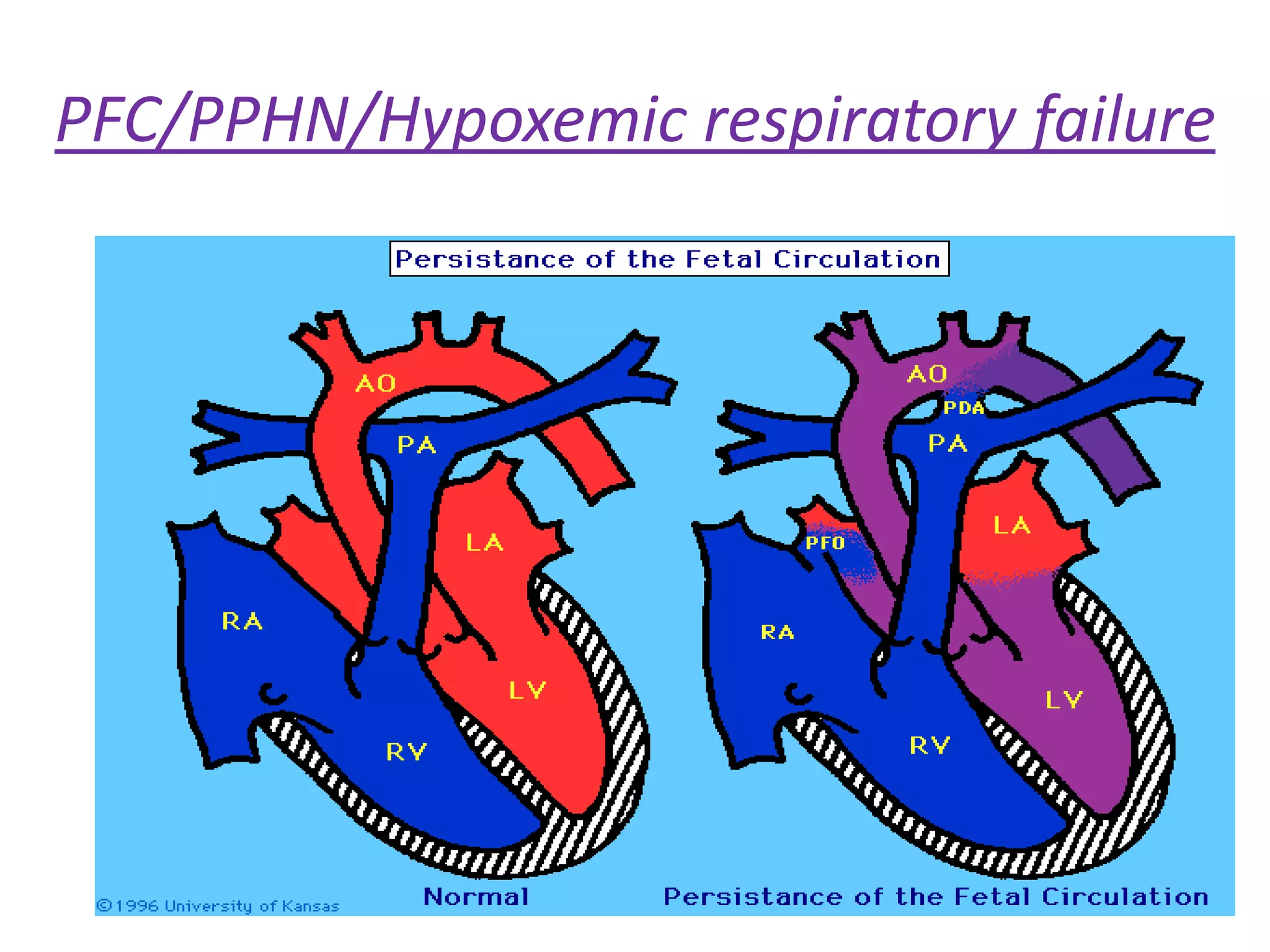 Persistent pulmonary hypertension of newborn PPHN | PPTX