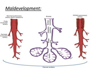 Persistent pulmonary hypertension of newborn PPHN | PPTX