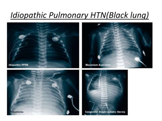 Persistent pulmonary hypertension of newborn PPHN | PPTX | Lung and ...