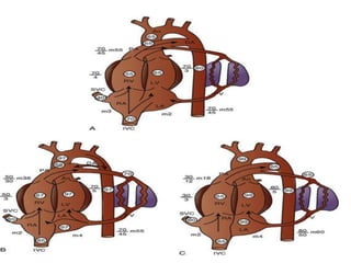 Persistent pulmonary hypertension of newborn PPHN | PPTX