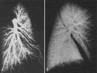 Persistent pulmonary hypertension of newborn PPHN | PPTX | Lung and ...