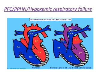 Persistent pulmonary hypertension of newborn PPHN | PPTX