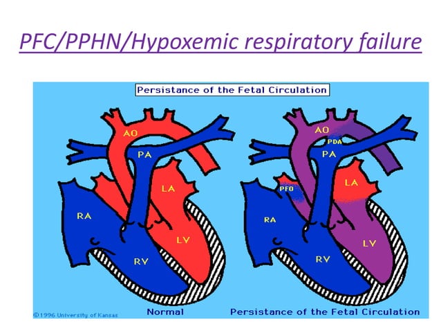 Persistent pulmonary hypertension of newborn PPHN | PPTX | Lung and ...