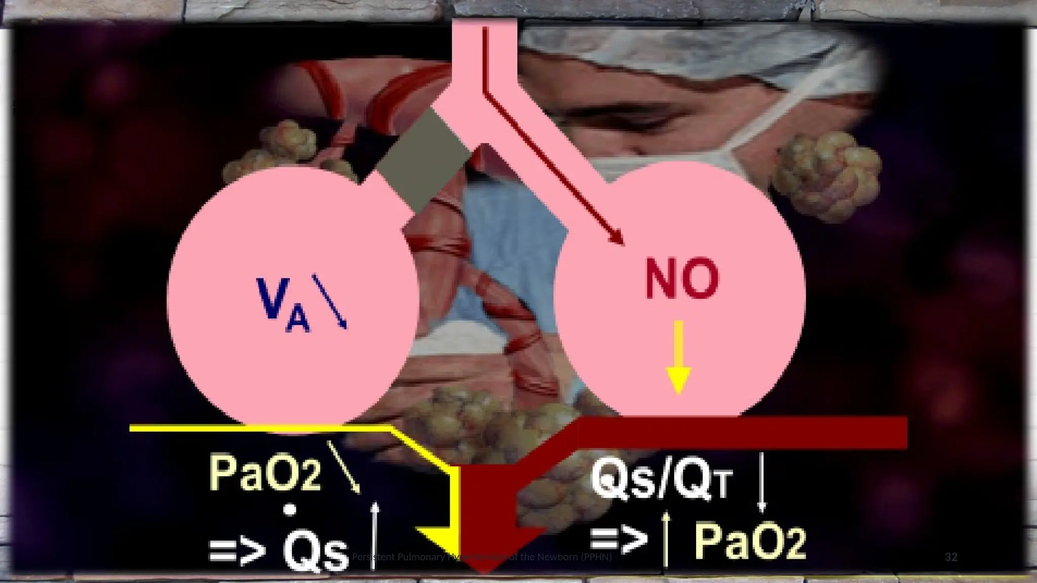 Persistent Pulmonary Hypertension of the Newborn.pptx