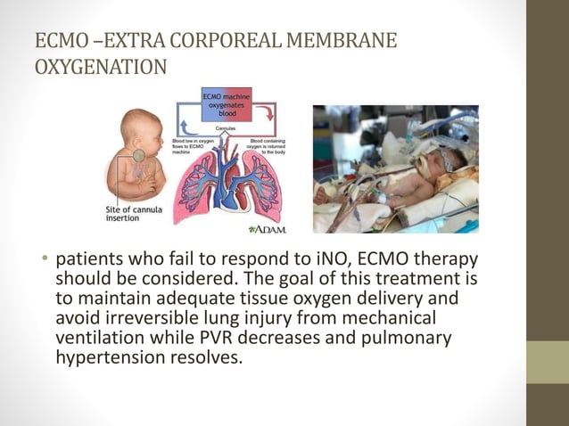 Persistent pulmonary hypertension(pphn) | PPT