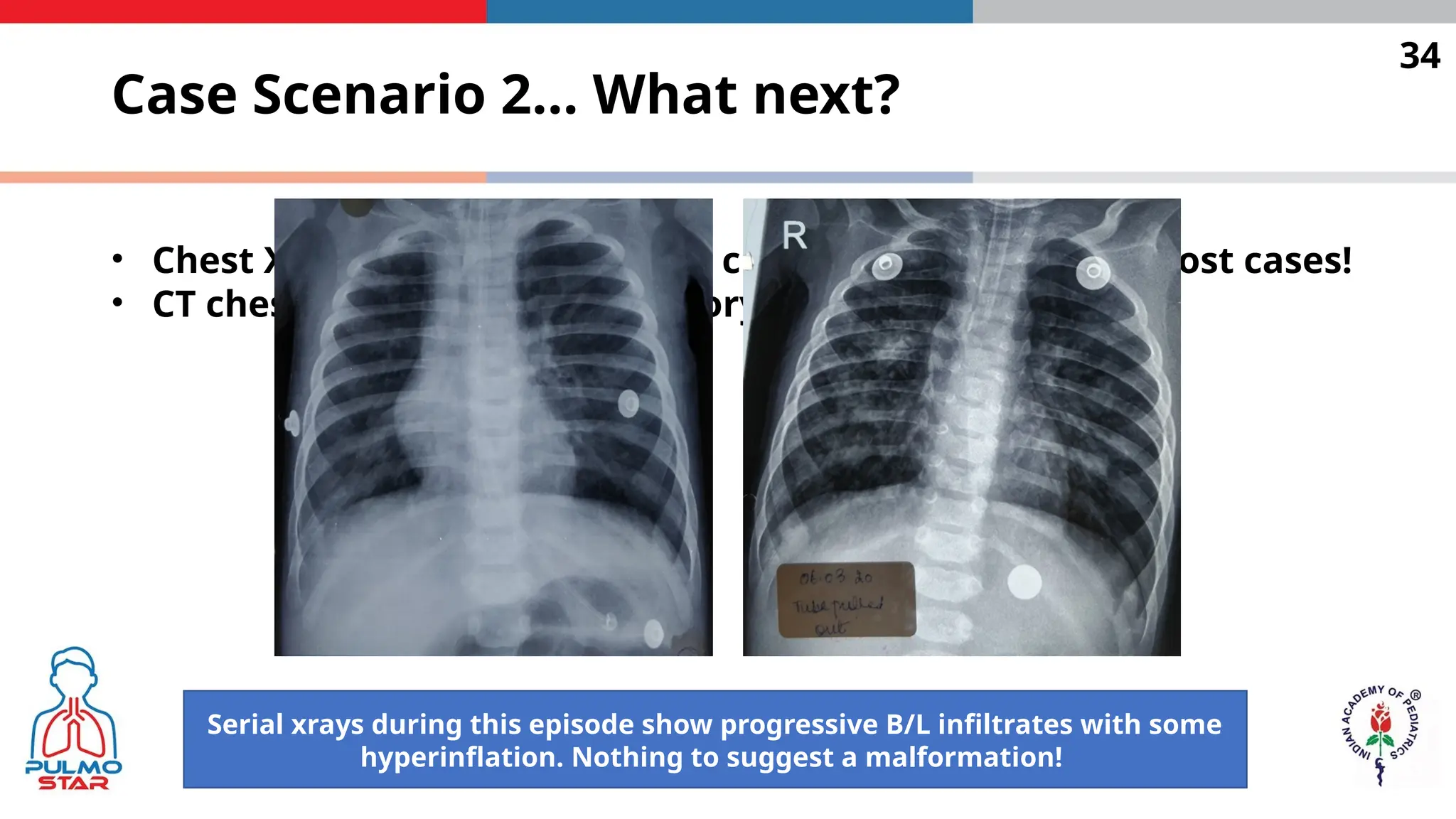 "Persistent and Recurrent Cough: Causes, Diagnosis, and Management in ...