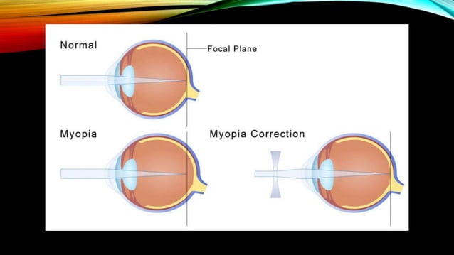 Personal health issues and concerns Grade 6 MAPEH | PPTX | Eye and ...
