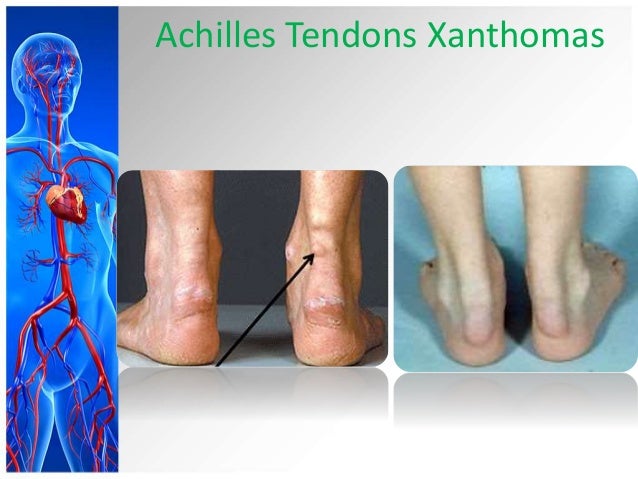 Tendon Xanthomata Rated Medicine