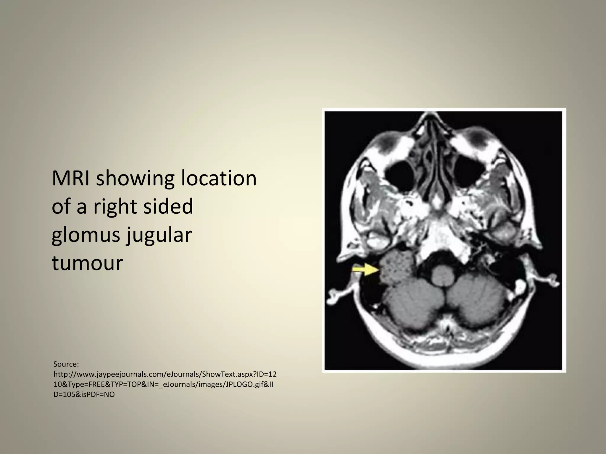 Personal journey with a glomus jugulare tumour2 | PPT