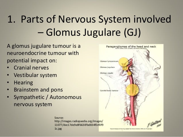 Personal journey with a glomus jugulare tumour2
